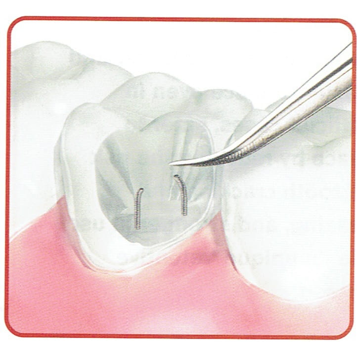 FILPIN - Filhol Dental